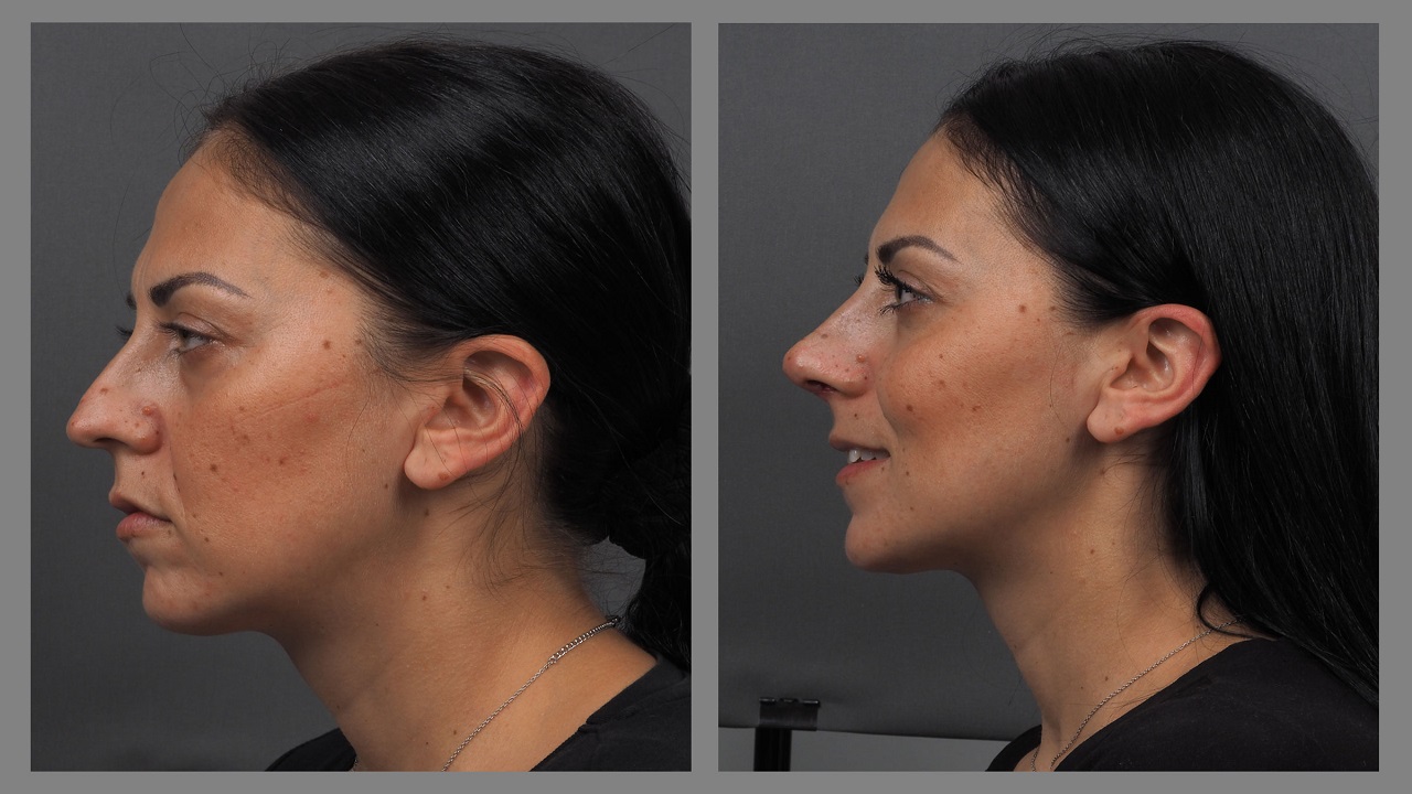 Rinoplastiki-me-yperihous-prin-kai-meta-dexi-profil-Rhinoplasty-with ...
