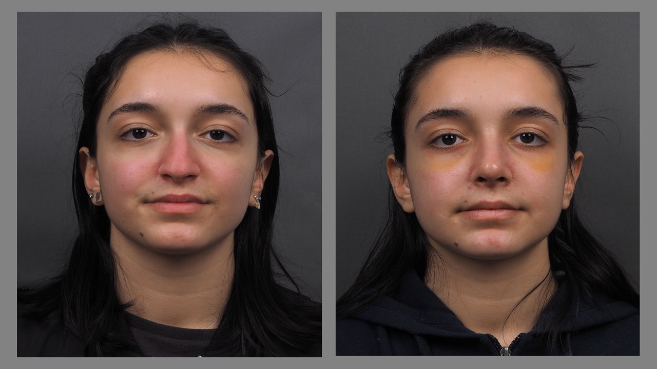Rinoplastiki-prin-kai-meta-Rhinoplasty-before-and-after-enface-Brouma ...