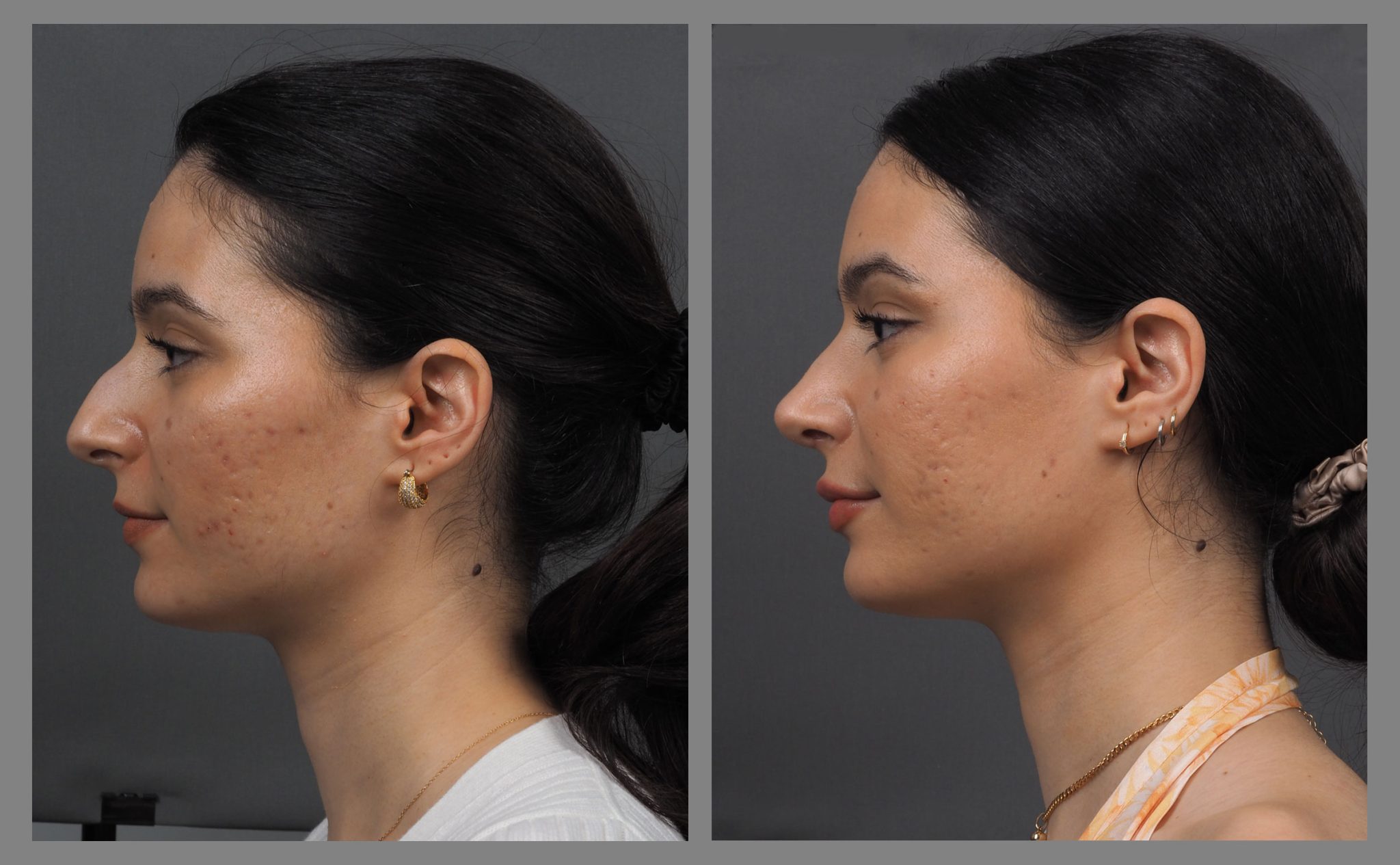 Ρινοπλαστική με υπερήχους : Diamond Rhinoplasty