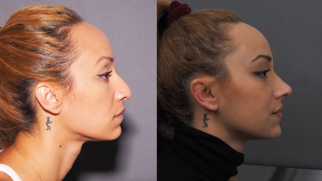 Ρινοπλαστική με υπερήχους : Diamond Rhinoplasty
