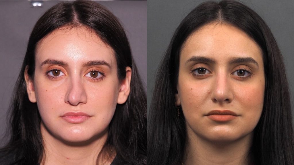 Αποτυχημένη Ρινοπλαστική | Διόρθωση με επανεπέμβαση